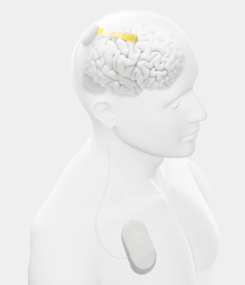 Layer 7 Cortical Interface: Neuro's Revolutionary Brain Implant - Brain Computer Interface